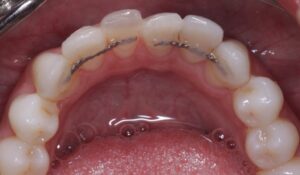 Broken Permanent Retainer? Here's What You Can Do. - SportingSmiles Dental